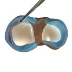 Partial Arthroscopic Meniscectomy | Academy Orthopedics