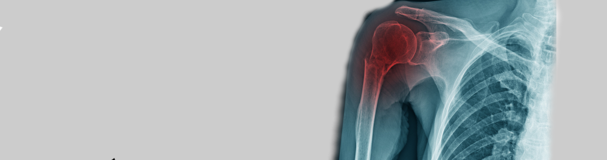 Shoulder Fracture - Academy Orthopedics