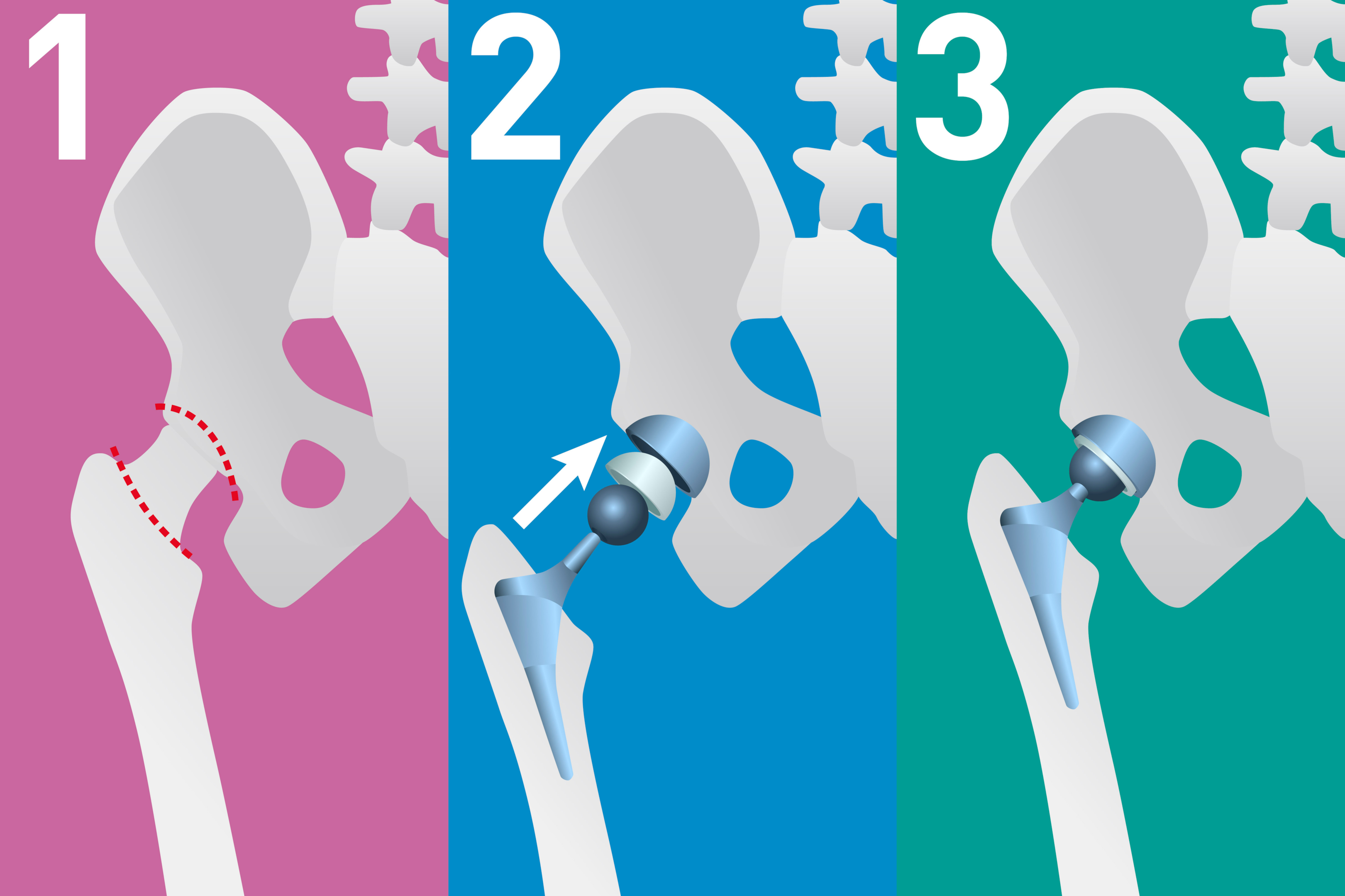 What To Know About Anterior Hip Replacement What To Know About Anterior Hip Replacement