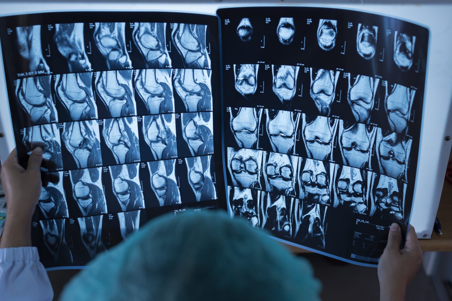 From Pain to Progress: Identifying Fractured Tibia Symptoms and Seeking ...